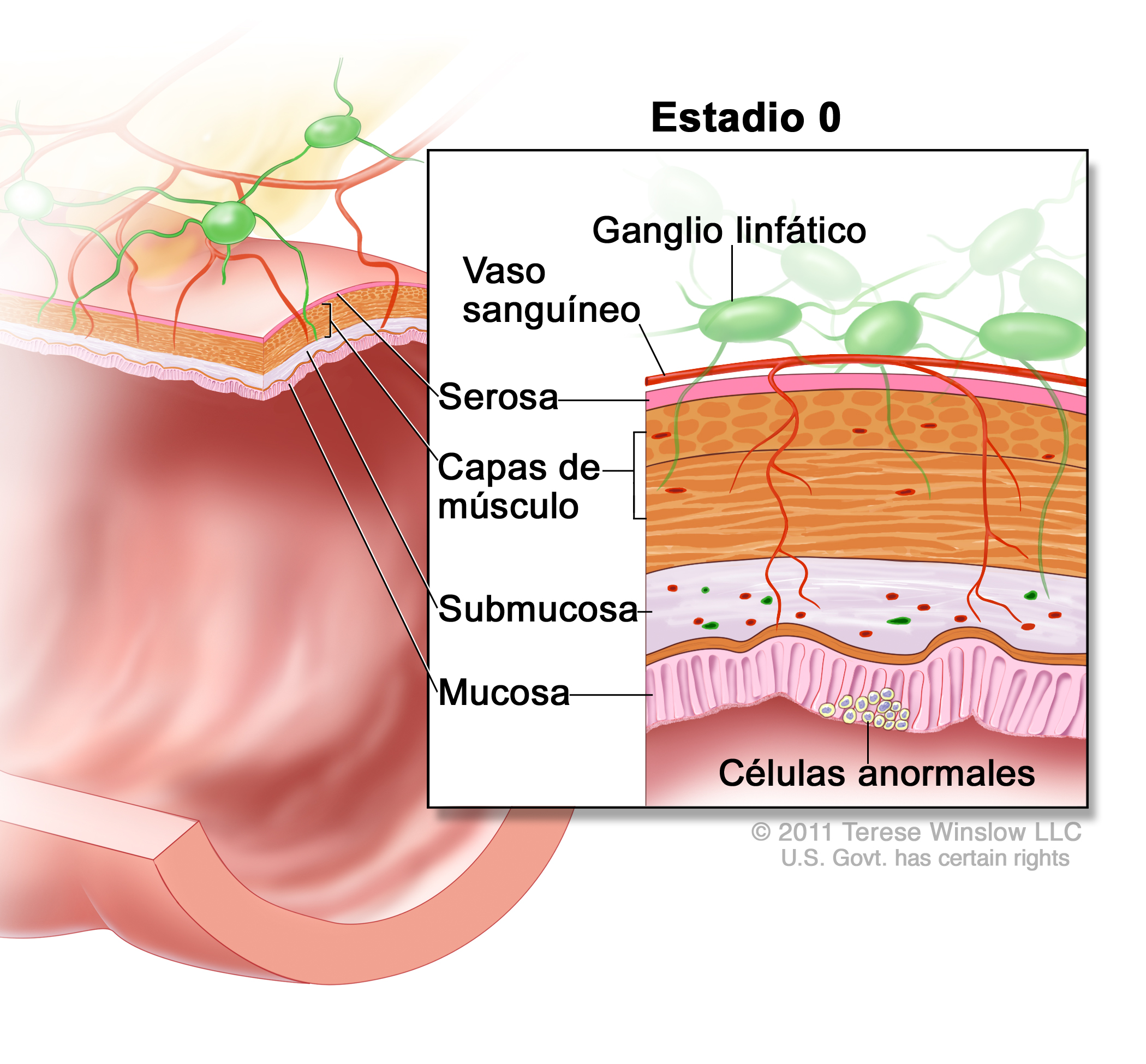 CÃ¡ncer de colon: Tratamiento (PDQ®) | Cure Today